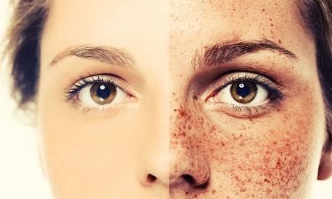 Melasma: o que é, causas, sintomas e diagnóstico - Área de Mulher
