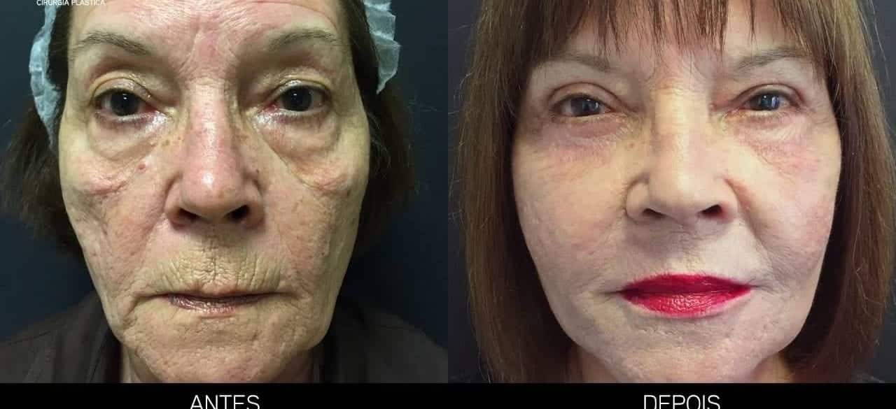 Lifting - o que é e como funciona a técnica que elimina a flacidez