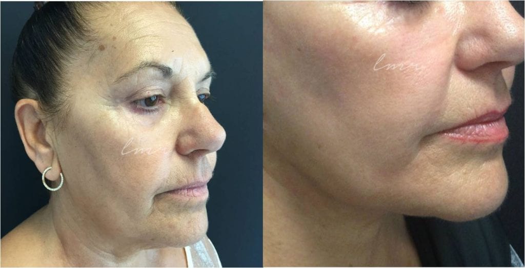 Lifting - o que é e como funciona a técnica que elimina a flacidez