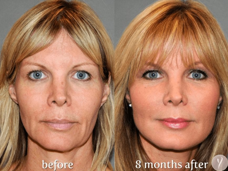 Lifting - o que é e como funciona a técnica que elimina a flacidez