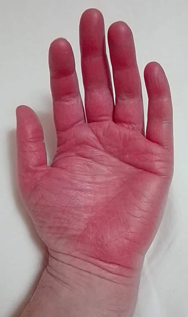Doença de Raynaud - Sensibilidade demais ao frio pode ser grave sintoma