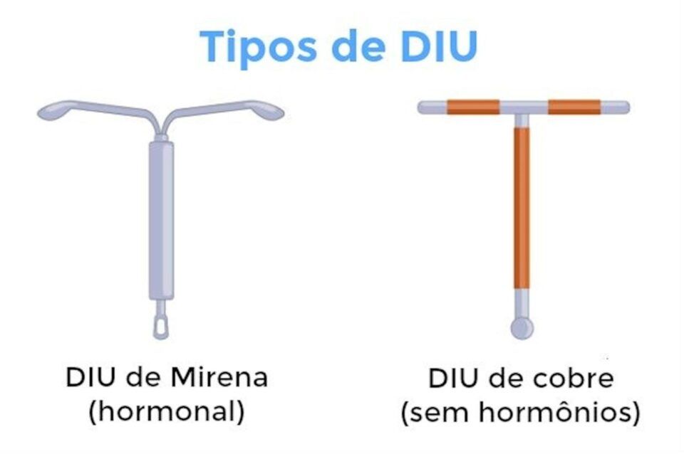 Como funciona o DIU? De cobre e Mirena, vantagens + eficácia do método