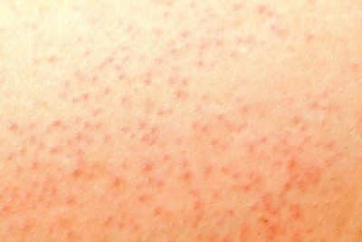 Irritação na virilha - Principais causas da irritação da região e ...