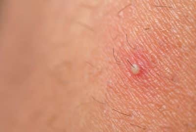 Foliculite no couro cabeludo - O que é, tipos e tratamentos