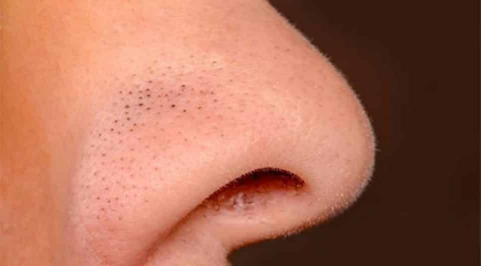 Cravo no rosto, como se formam? Dicas para se livrar deles